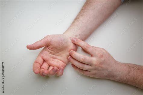 Patient Showing Red Itchy Rash On Wrist And Fingers Dermatitis Eczema