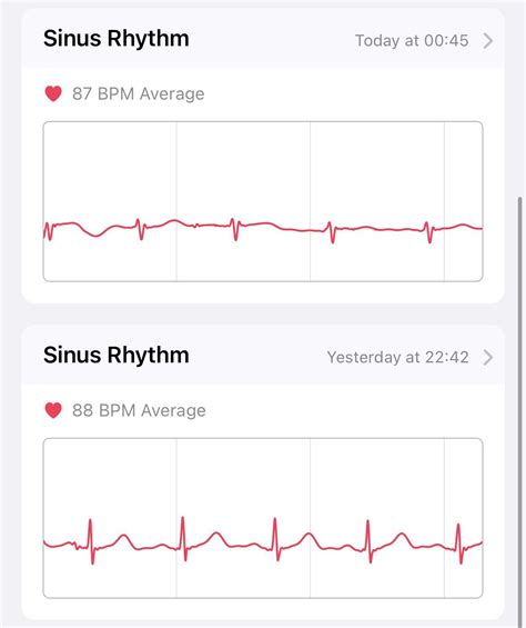 Whats The Difference Between These Two ECGs R Medical