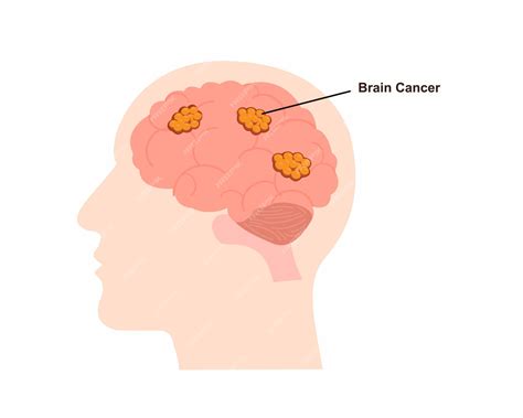 Premium Vector Brain Cancer Or Tumor In Head Human Brain Anatomy