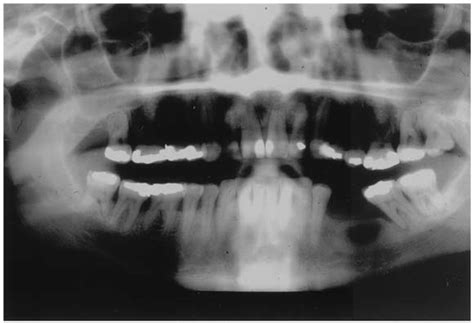 Anterior Lingual Mandibular Salivary Gland Defect Stafne Defect