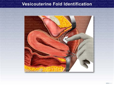 Vesicouterine Fold Identification Trialquest Inc