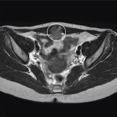 Magnetic Resonance Imaging Showing A Subcutaneous Mass With An