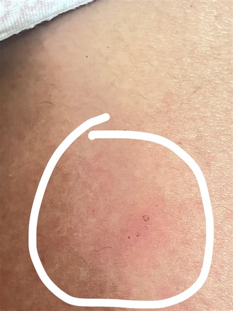 What Bug Bites Look Like This R Bugbites