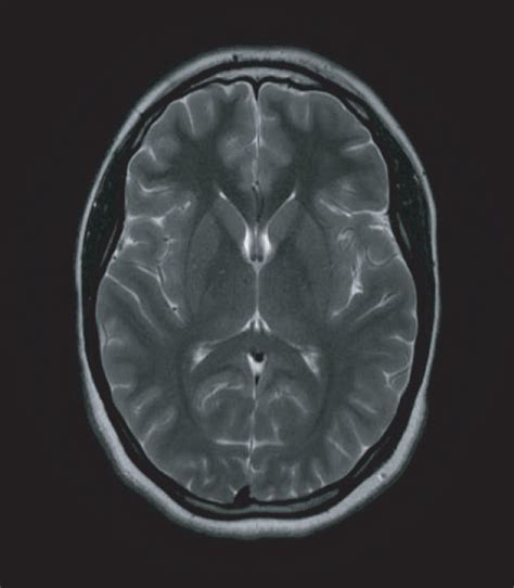 Brain Tumor Dataset A No Tumor And B Brain Tumor Download