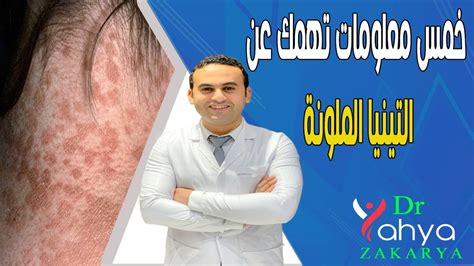 👈 خمس معلومات تهمك عن التينيا الملونة Pityriasis Versicolour 👩‍🏫 Youtube