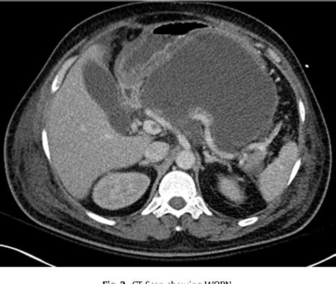 Figure 2 From A Standardized Method For Endoscopic Necrosectomy