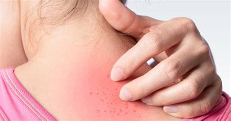 Options For Treating Polymorphous Light Eruption