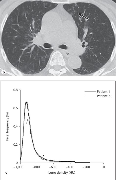 Figure 1 From Computed Tomography Analysis Of Airway Dimensions And