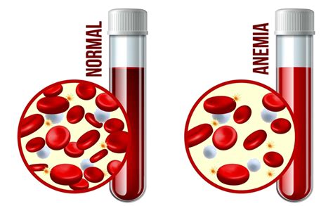 Anemia Of Chronic Disease Causes Symptomsand Treatment