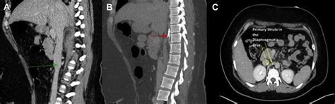 A Sagittal Contrast Enhanced Computed Tomography Scan Showing Patent