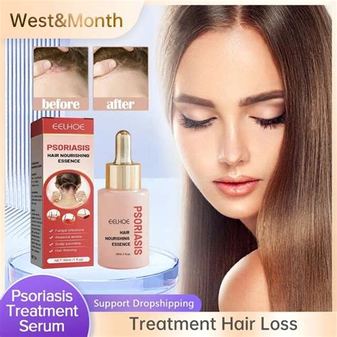 Psoriasis Scalp Treatment