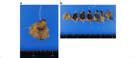 The Excisional Biopsy Yielded The Diagnosis Of Angiosarcoma The Download Scientific Diagram