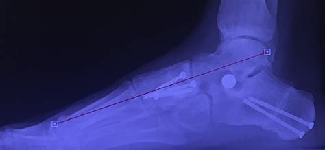 Subtalar Implant Navicular Cuneiform Fusion Robert Sheinberg Dpm