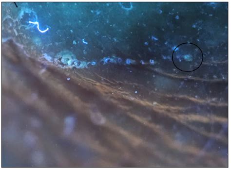 Scabies Mite Dermoscopy