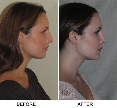 Septoplasty And Turbinate Reduction Renew Physical Therapy