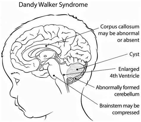 Dandy Walker Syndrome Causes Symptoms Diagnosis Treatment And Prognosis