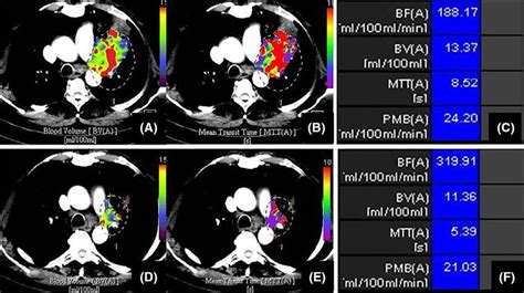 Quantification Of Tumor Response To Treatment Using Perfusion Ct Download Scientific Diagram