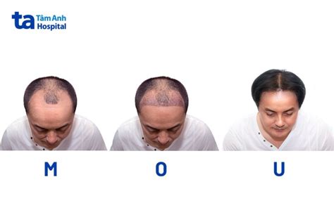Rụng tóc nhiều ở nam giới Nguyên nhân dấu hiệu và ngăn ngừa