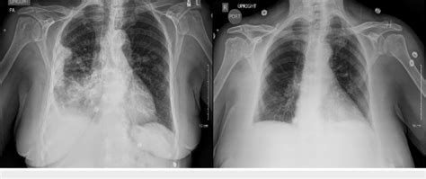 Posteroanterior And Portable Chest X Ray Left Figure Posteroanterior
