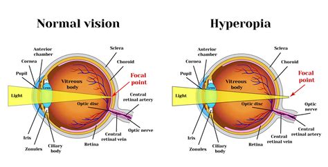 Hyperopia Exercises