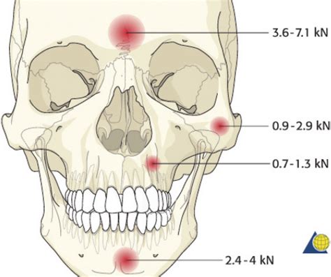 63 Frontal Sinus And Naso Orbito Ethmoid Fractures Plastic Surgery Key