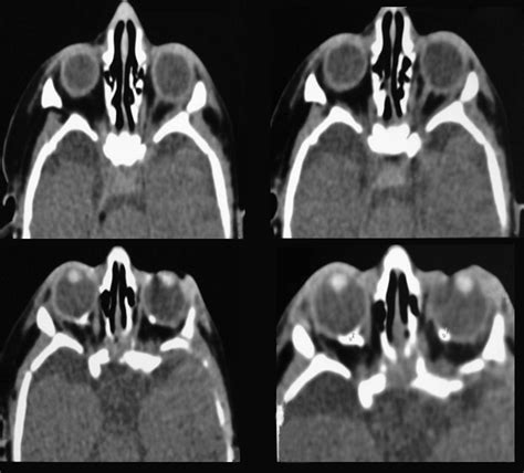 Axial Non Contrast Ct Scan Of Brain And Orbit Shows Fat Density Lesions