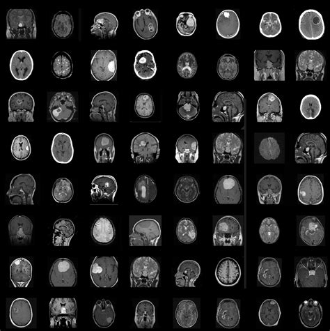 Diagnosing Classifying And Predicting Brain Tumors From Mri Images Using Vgg 19 And Ann