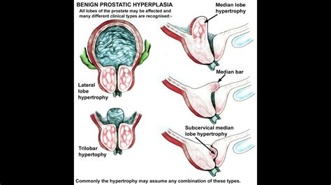Benign Prostatic Hypertrophy