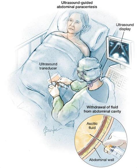 Itching After Paracentesis At Bryan Hanes Blog