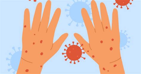 국내 성인 아토피피부염 환자 절반 이상이 고위험군