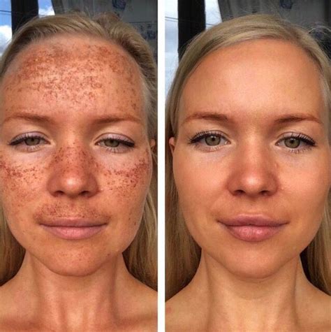 Microneedling Vs Microdermabrasion Vs Dermaplaning Results Artofit