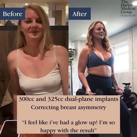 Small Breast Implants Uk