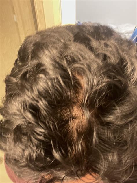 Infection Scalp Picking Stress Rashes Any Hope Of Recovery I Dont