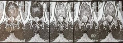 A Case Report Of Conus Medullaris Tumor