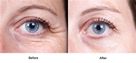 Botox For Crows Feet What To Expect Care And Recovery Tips