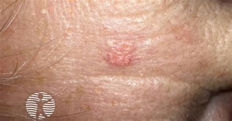 Sebaceous Hyperplasia Image