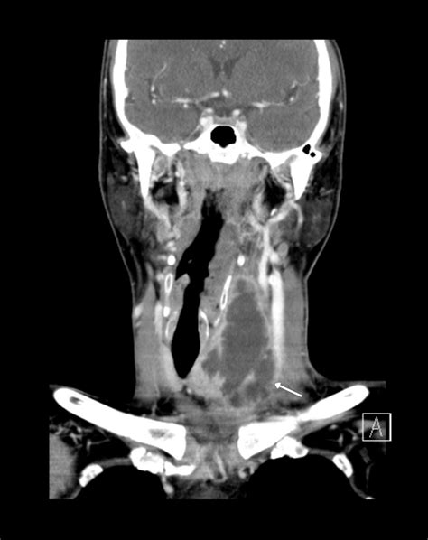 Pyriform Sinus Fistula