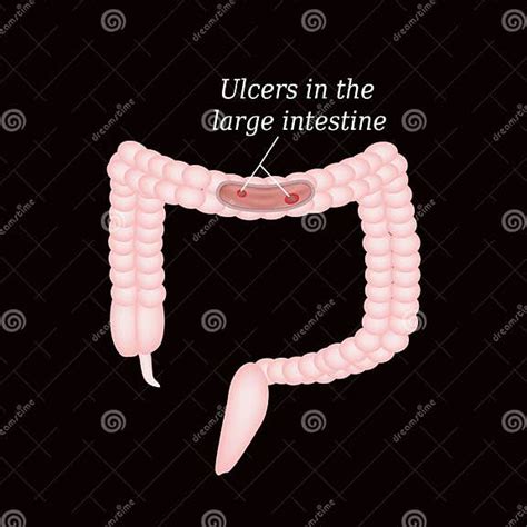 Ulcer Intestinal Ulcere în Colon Ilustrare Vectorială Pe Fond Negru