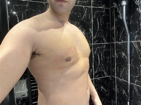 Gyno Surgery Before And After Rgynecomastia