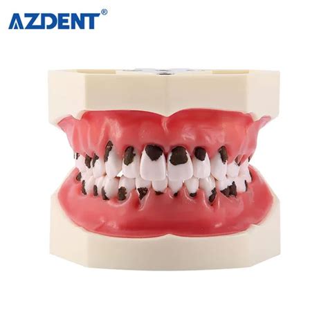 New Type Dental Calculus Exercise Model With Subgingival Calculus Hr