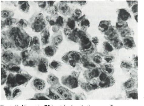 Figure 1 From Tissue Polypeptide Antigen Immunostaining In Fine Needle
