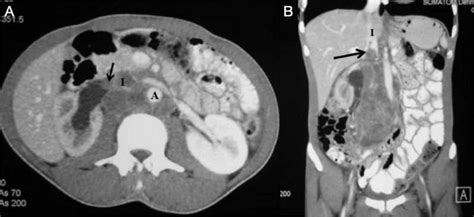 Retroperitoneal Ivc Leiomyosarcoma In A 28 Year Old Male With Abdominal