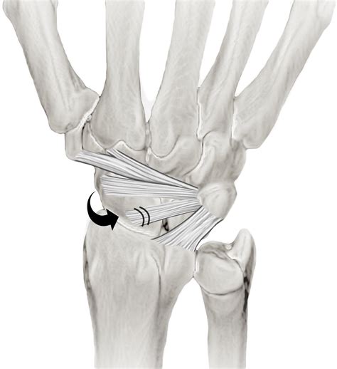 Preoperative And Postoperative Imaging Of Scapholunat