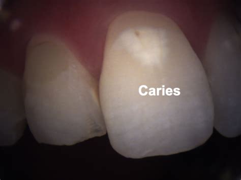 Caries Of Enamel And Dentin Flashcards Quizlet