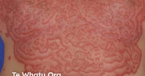 Erythema Gyratum Repens Like Appearance In Pemphigus Foliaceus Image