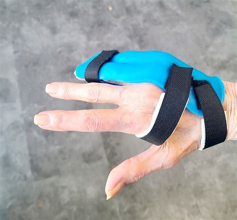Check Out This Custom Made Thermoplastic Hand Based Ulnar Gutter Splint