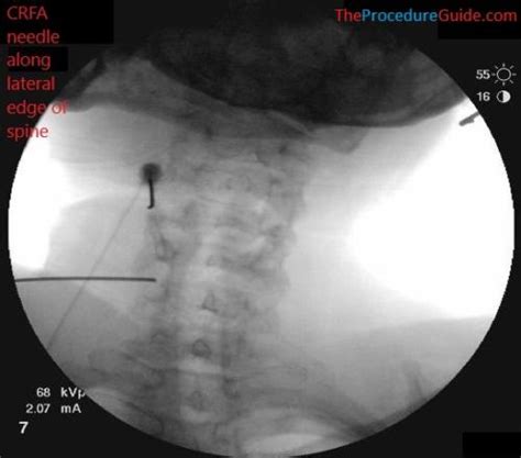 Fluoroscopic Guided Sacral Transforaminal Epidural Steroid Injection