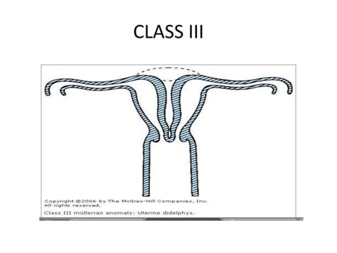 Congenital Abnormalities Of Reproductive System Pptx