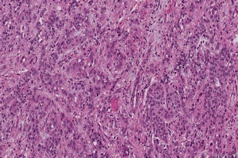 A The Nephrectomy Specimen Demonstrated Infiltrative Nests Of Tumor