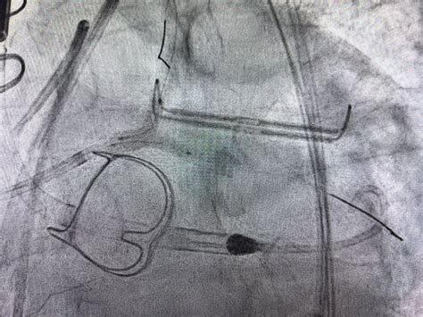 Amir Kaki Md On Twitter 80 Y O With Severe Bifurcation Lm Medina 1 1 1 Heavily Calcified